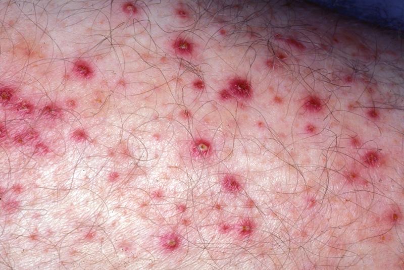 Living Unproductive -Polycythemia Vera A Blood Cancer | Bima Support ...